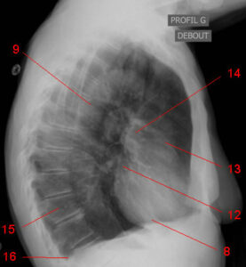 Chest X-ray - W-Radiology