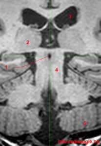 Midbrain - W-Radiology
