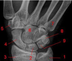 Wrist Radiographs - W-Radiology