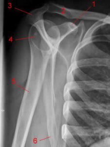 Shoulder X-Ray - W-Radiology
