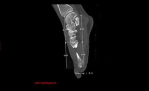 MRI of the Ankle: Detailed Anatomy - W-Radiology