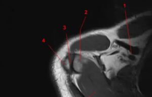 Atlas of Shoulder MRI Anatomy - W-Radiology