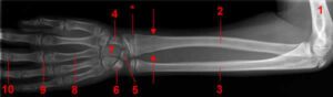 Forearm X-ray - W-Radiology