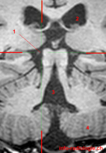 Cerebral Cisterns - W-Radiology