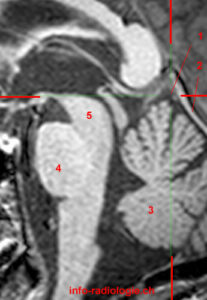 Cerebral Cisterns - W-Radiology
