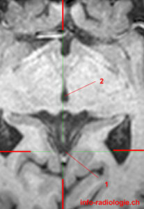 Cerebral Cisterns - W-Radiology