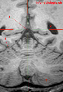 Cerebral Cisterns - W-Radiology