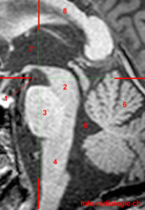 Cerebral Cisterns - W-Radiology
