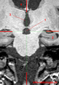 Cerebral Cisterns - W-Radiology