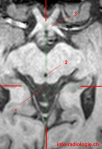 Cerebral Cisterns - W-Radiology